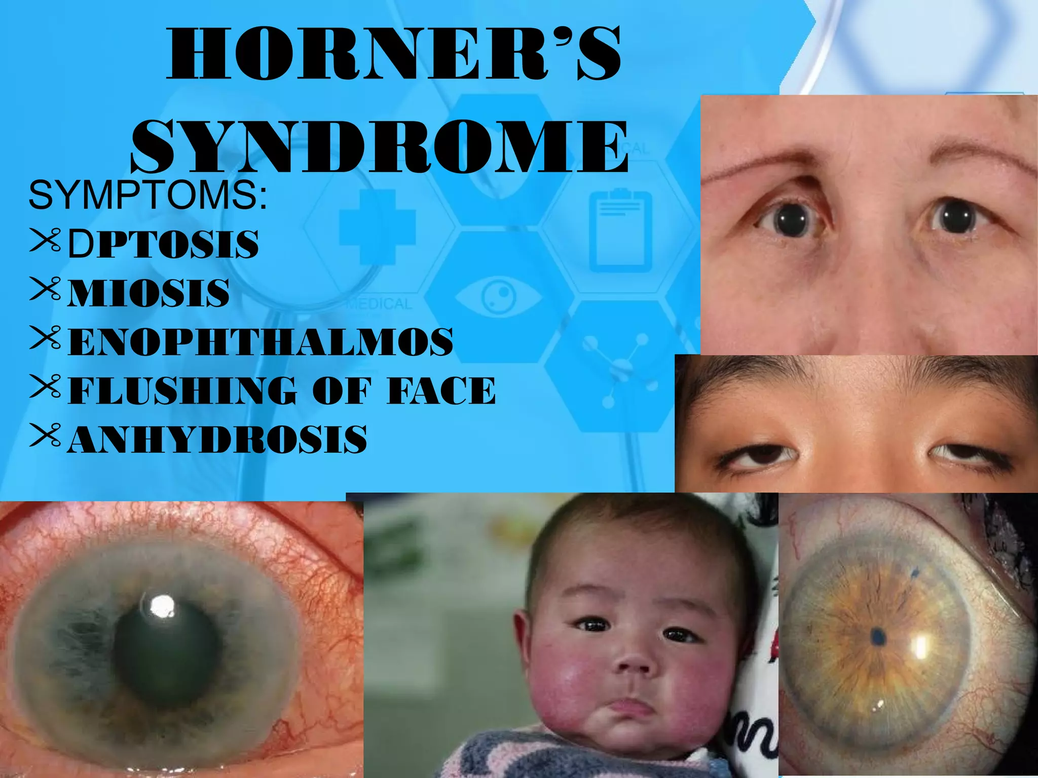 accommodation,reflexes,defects of vision | PPT