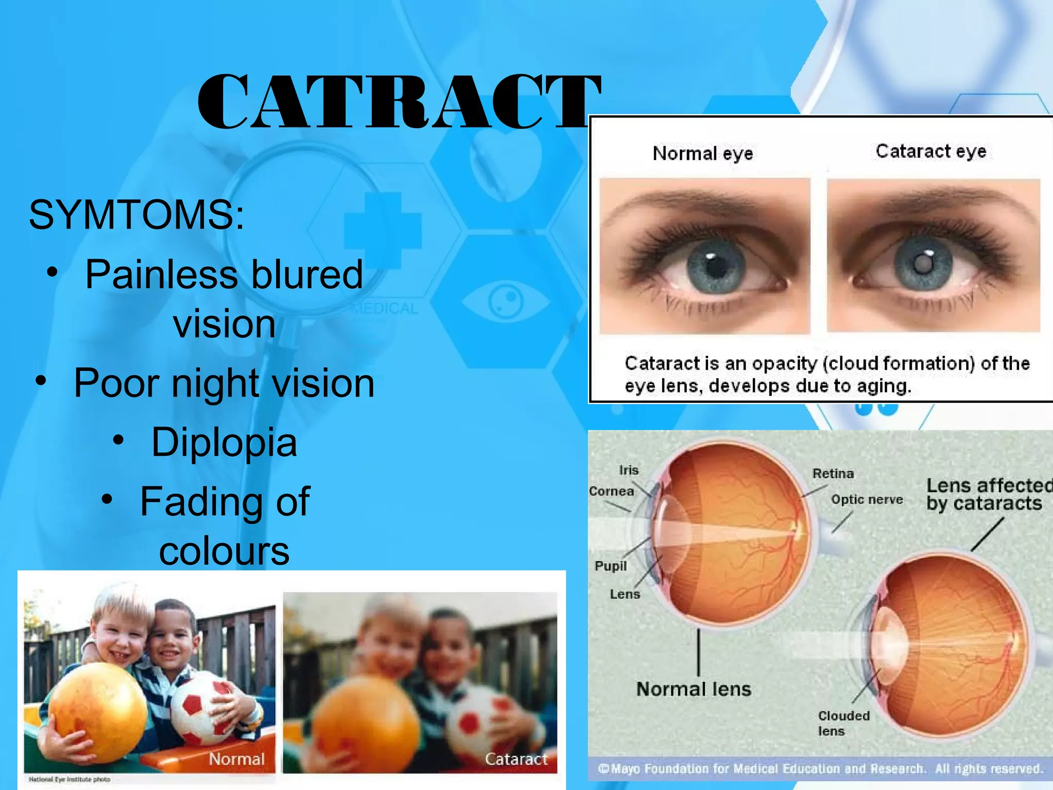 accommodation,reflexes,defects of vision | PPT