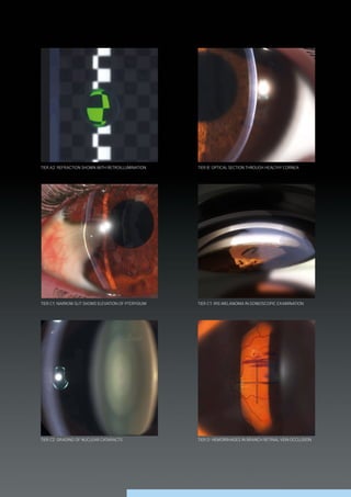 Eyesi Slit Lamp brochure | PDF