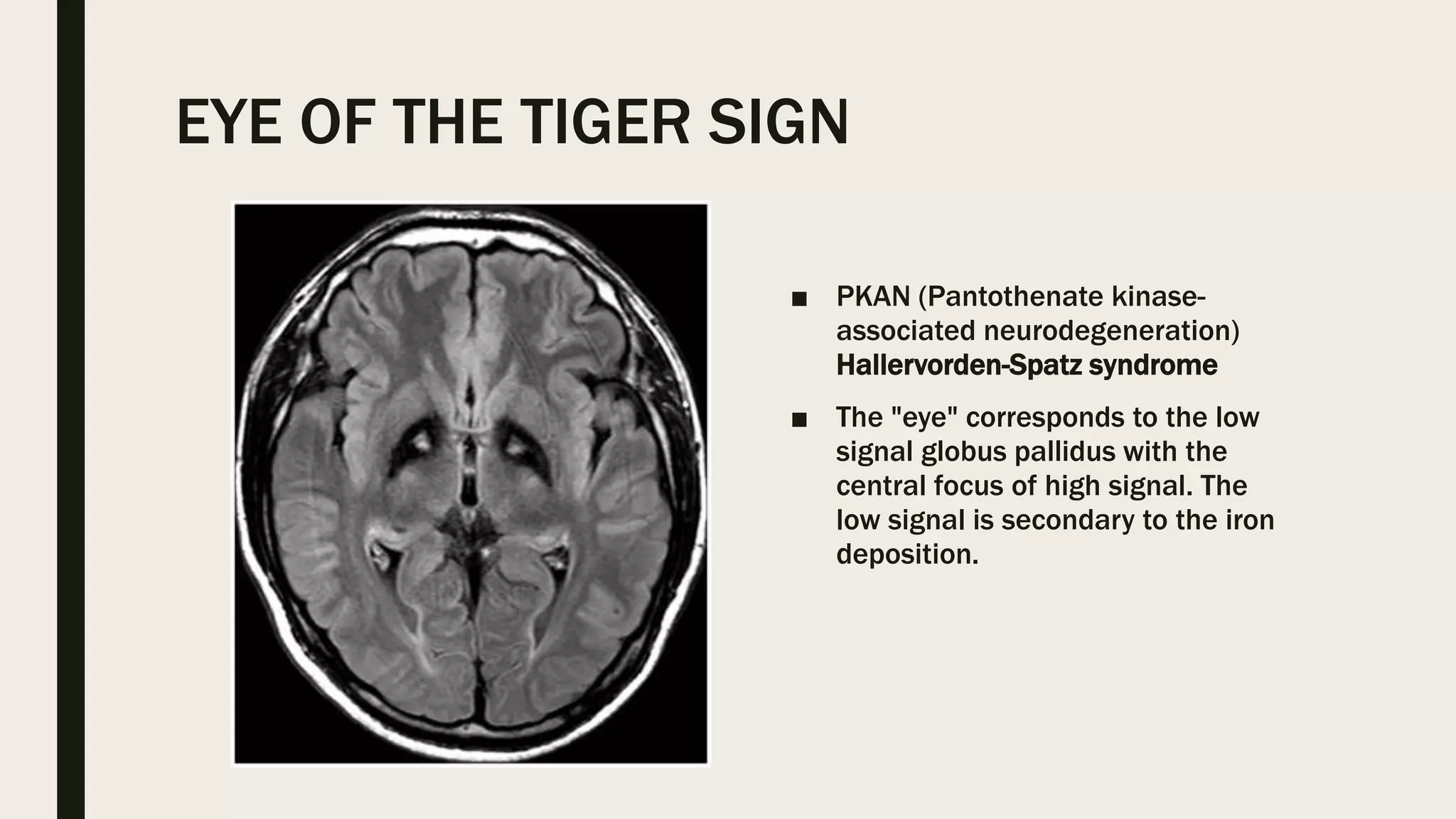 Eye signs in radiology | PPTX