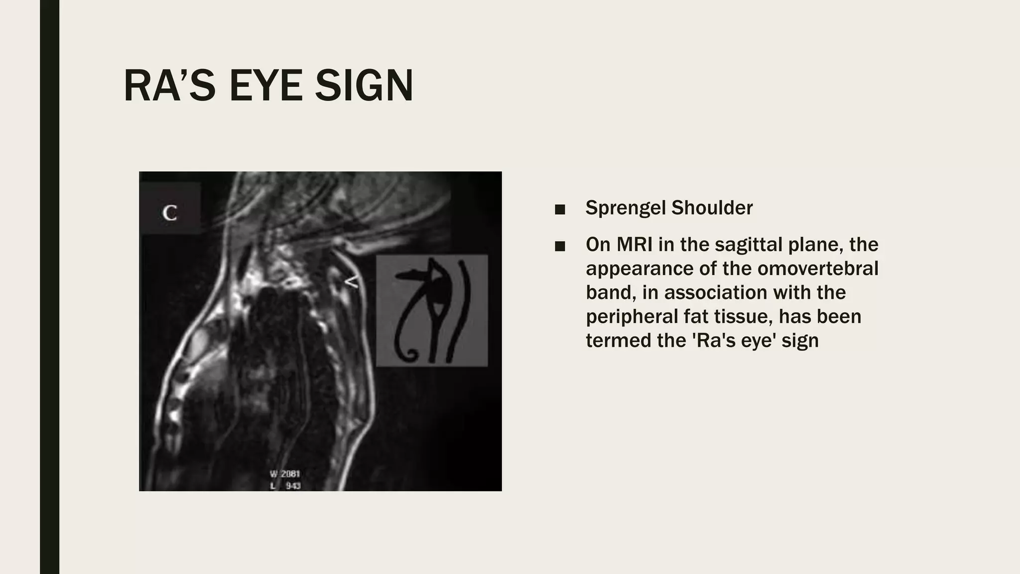 Eye signs in radiology | PPTX