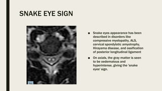 Eye signs in radiology | PPTX