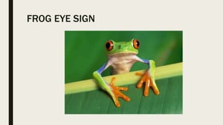 Eye signs in radiology | PPTX