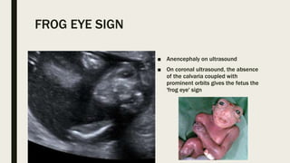 Eye signs in radiology | PPTX