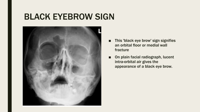 Eye signs in radiology | PPTX | Eye and Vision Conditions | Diseases ...