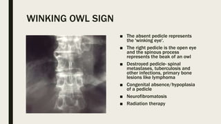 Eye signs in radiology | PPTX