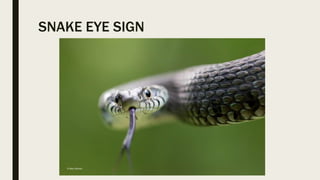 Eye signs in radiology | PPTX