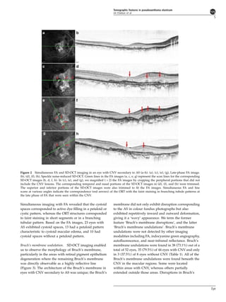 Tomographic fundus features in Pseudoxanthoma Elasticum | PDF