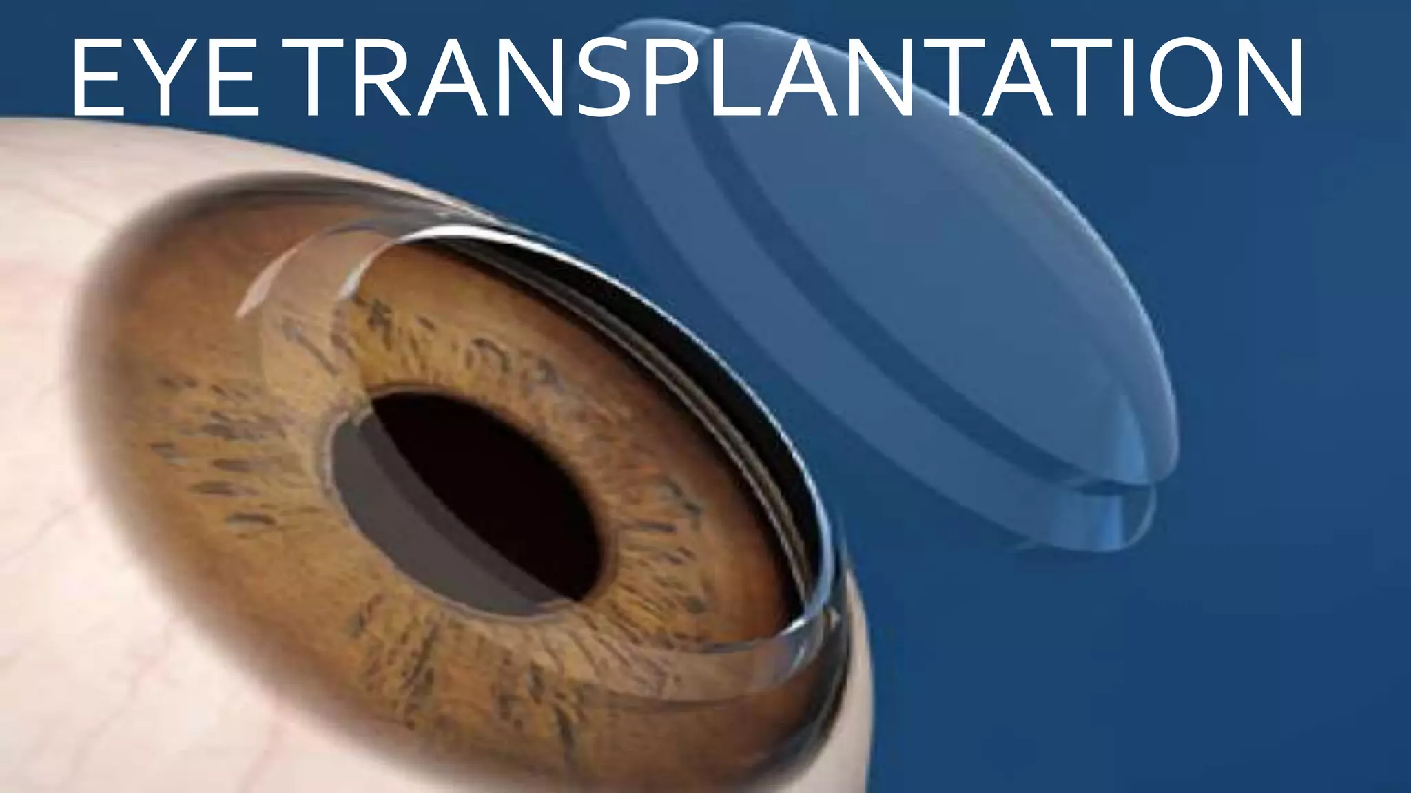 Eye transplantation | PPTX