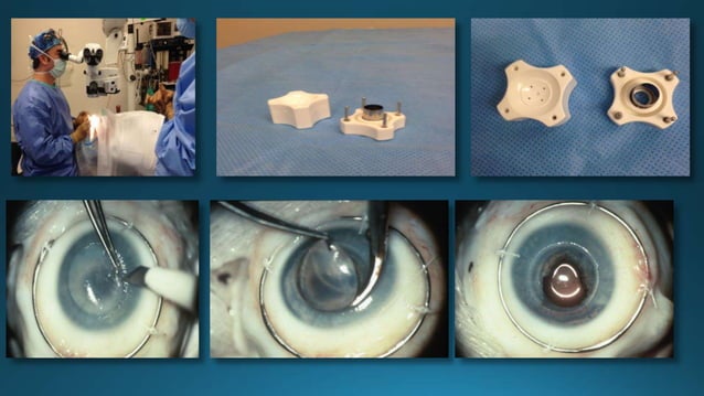 Eye transplantation | PPTX