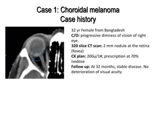 Eye tumours | PPTX | Eye and Vision Conditions | Diseases and Conditions