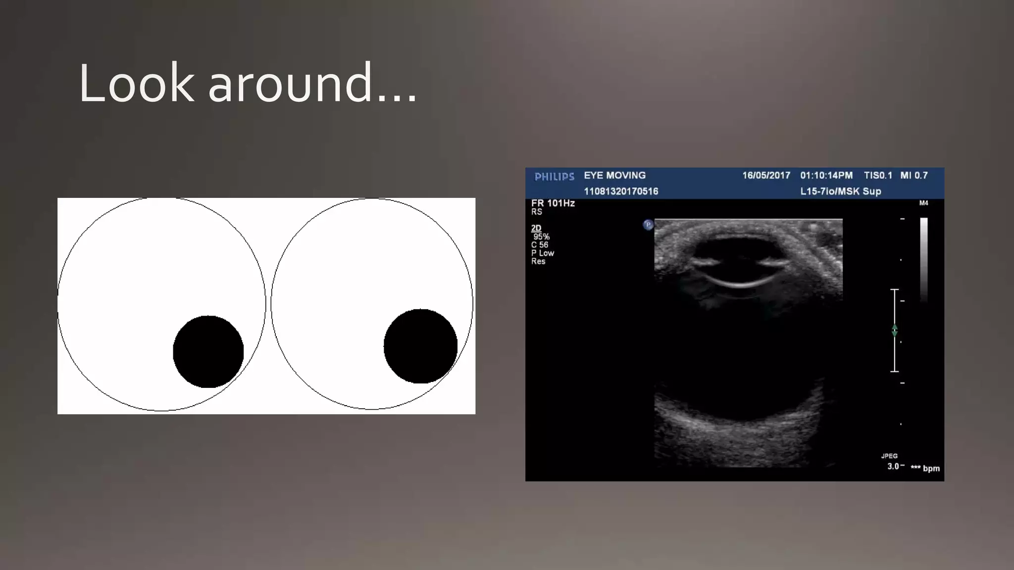 Eye ultrasound 2017 | PPT