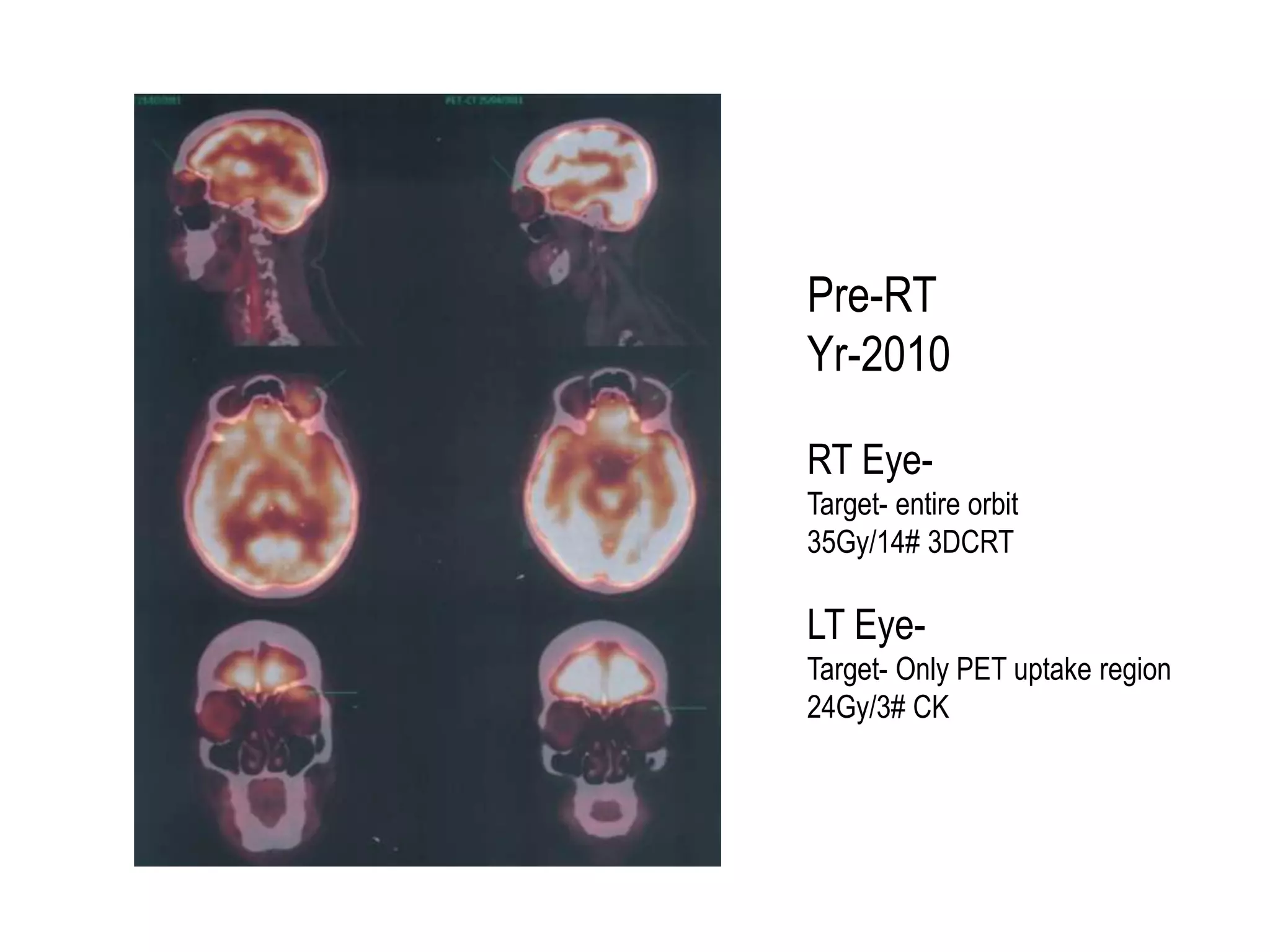 Robotic Radiosurgery Treatment for Eye Tumours | PPTX