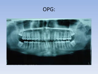 condylar_fracture_Anas_shoaib.ppt