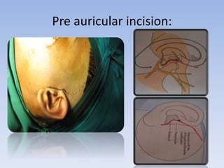 condylar_fracture_Anas_shoaib.ppt