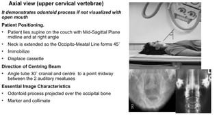 RADIOGRAPHIC TECHNIQUE ON CERVICAL VERTEBRAE AND THORACIC INLET | PPTX