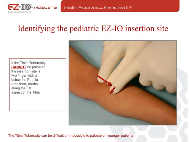 EZ I/O Presentation at FCA | PPTX | First Aid | Injuries