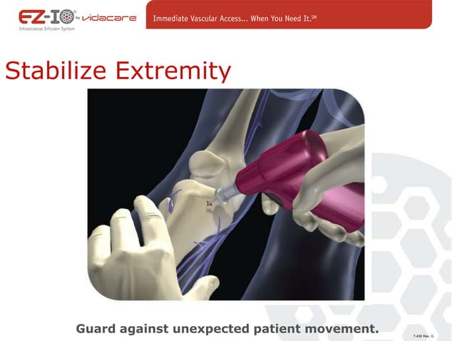 EZ I/O Presentation at FCA | PPTX | First Aid | Injuries