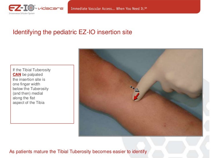 Intraosseus Placement in Pediatrics : r/medicine