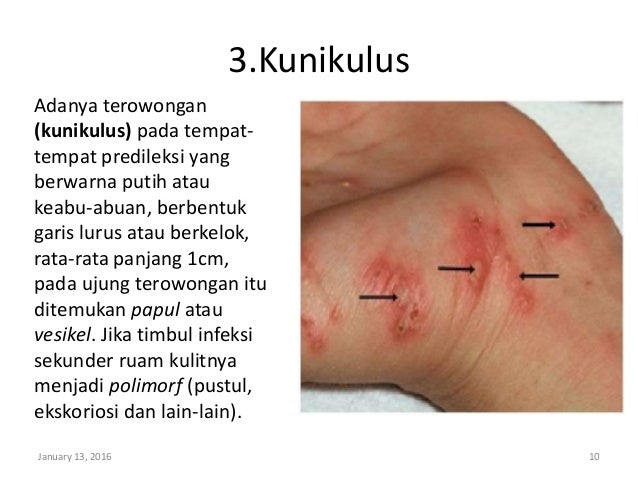 F.2 kes ling (skabies)ricka.docx