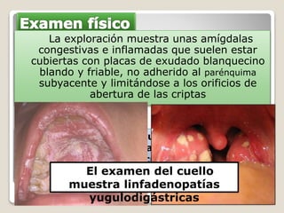 SEMIOLOGIA - Amigdalitis | PPTX