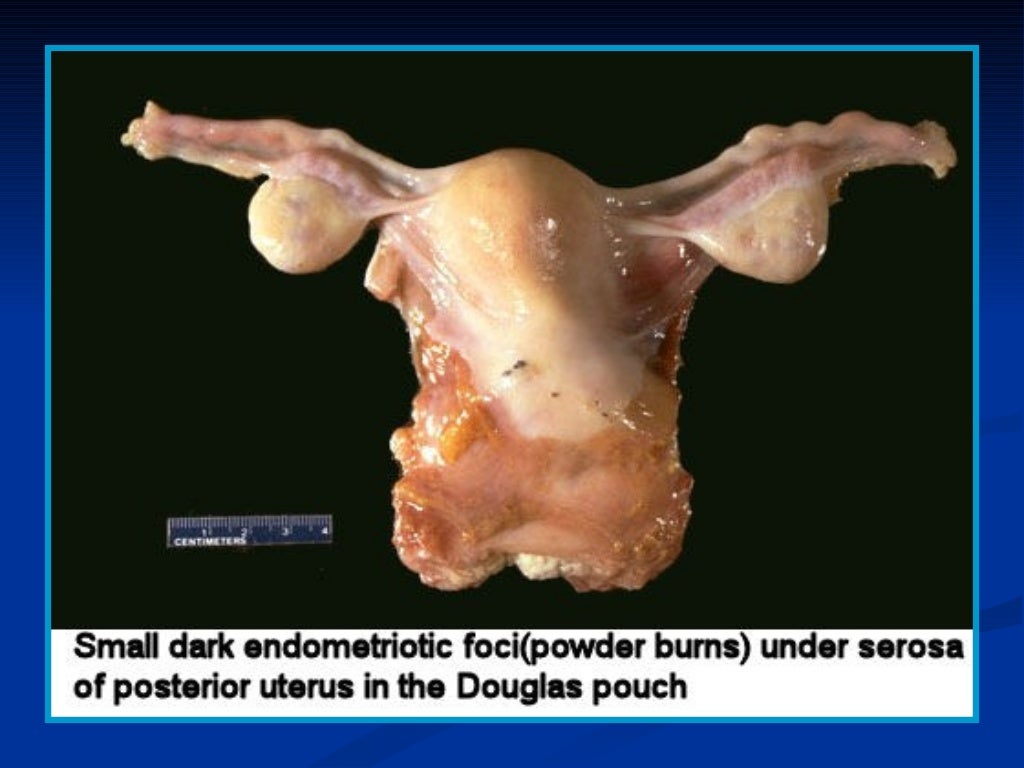 DISEASES OF THE FEMALE REPRODUCTIVE SYSTEM