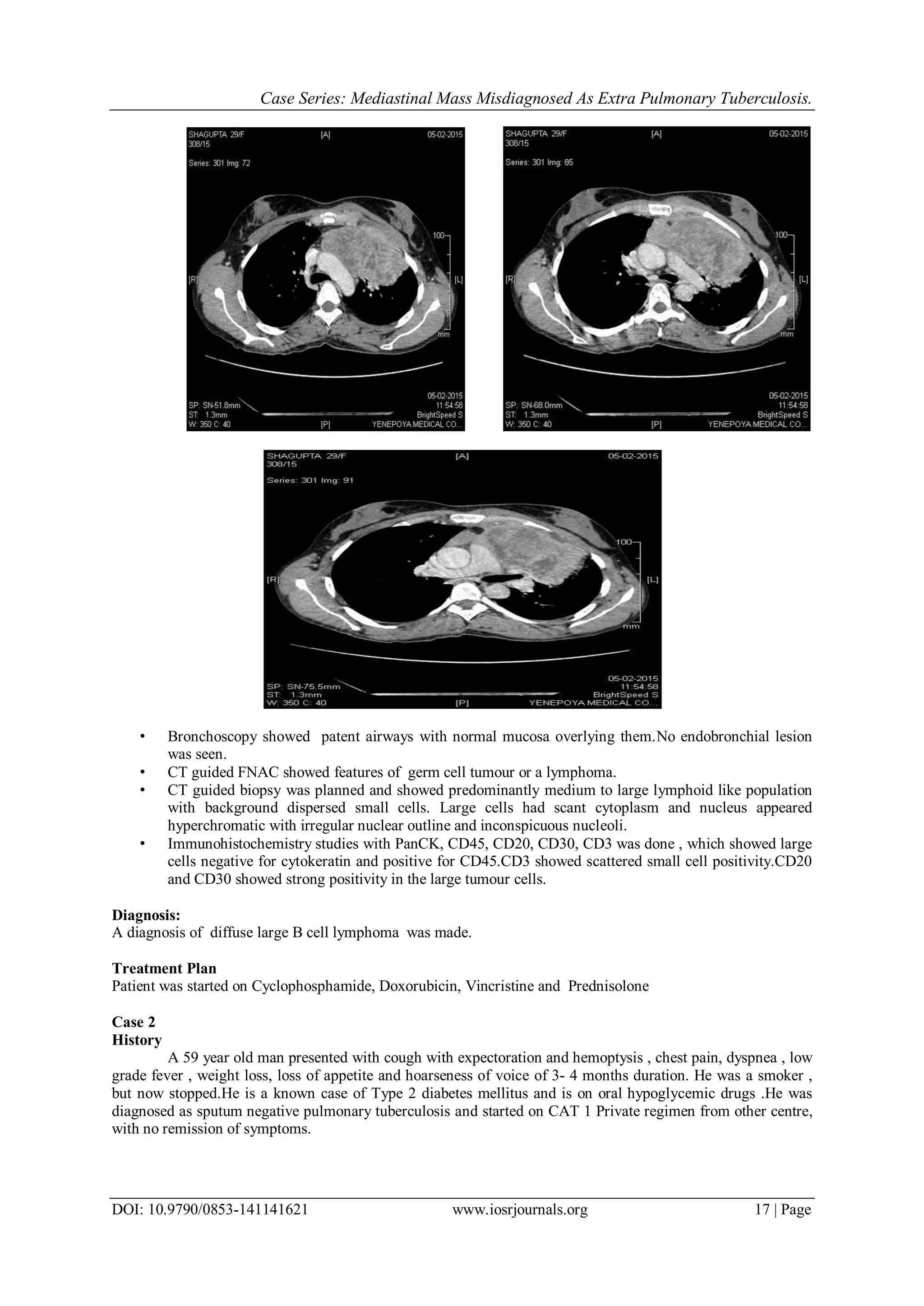 Case Series: Mediastinal Mass Misdiagnosed As Extra Pulmonary ...