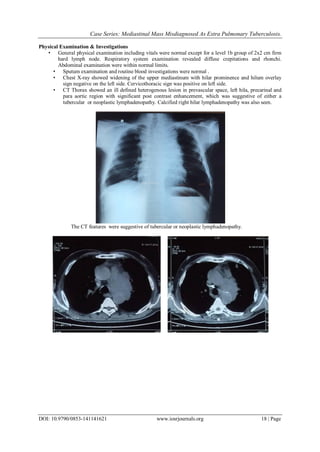 Case Series: Mediastinal Mass Misdiagnosed As Extra Pulmonary ...