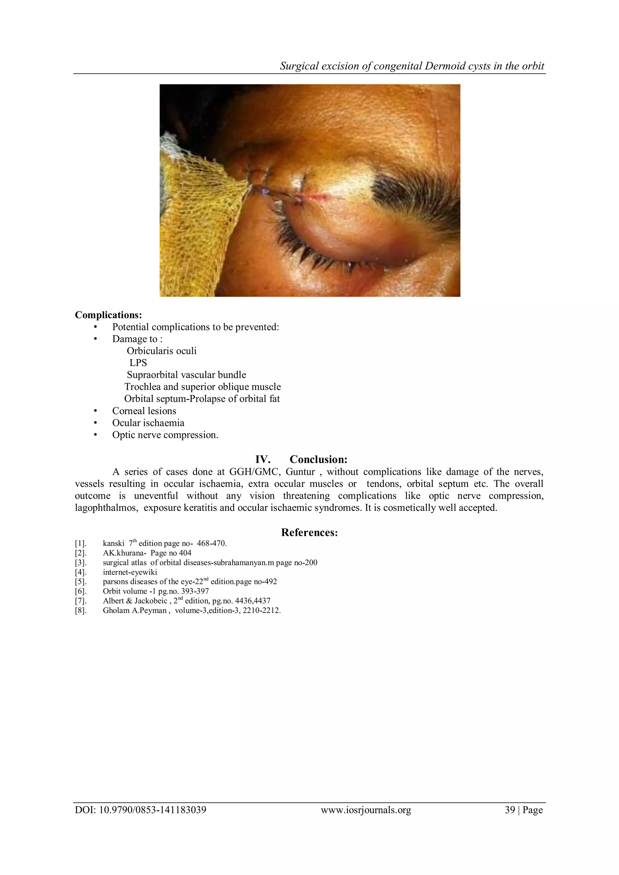 Surgical excision of congenital Dermoid cysts in the orbit | PDF | Eye ...