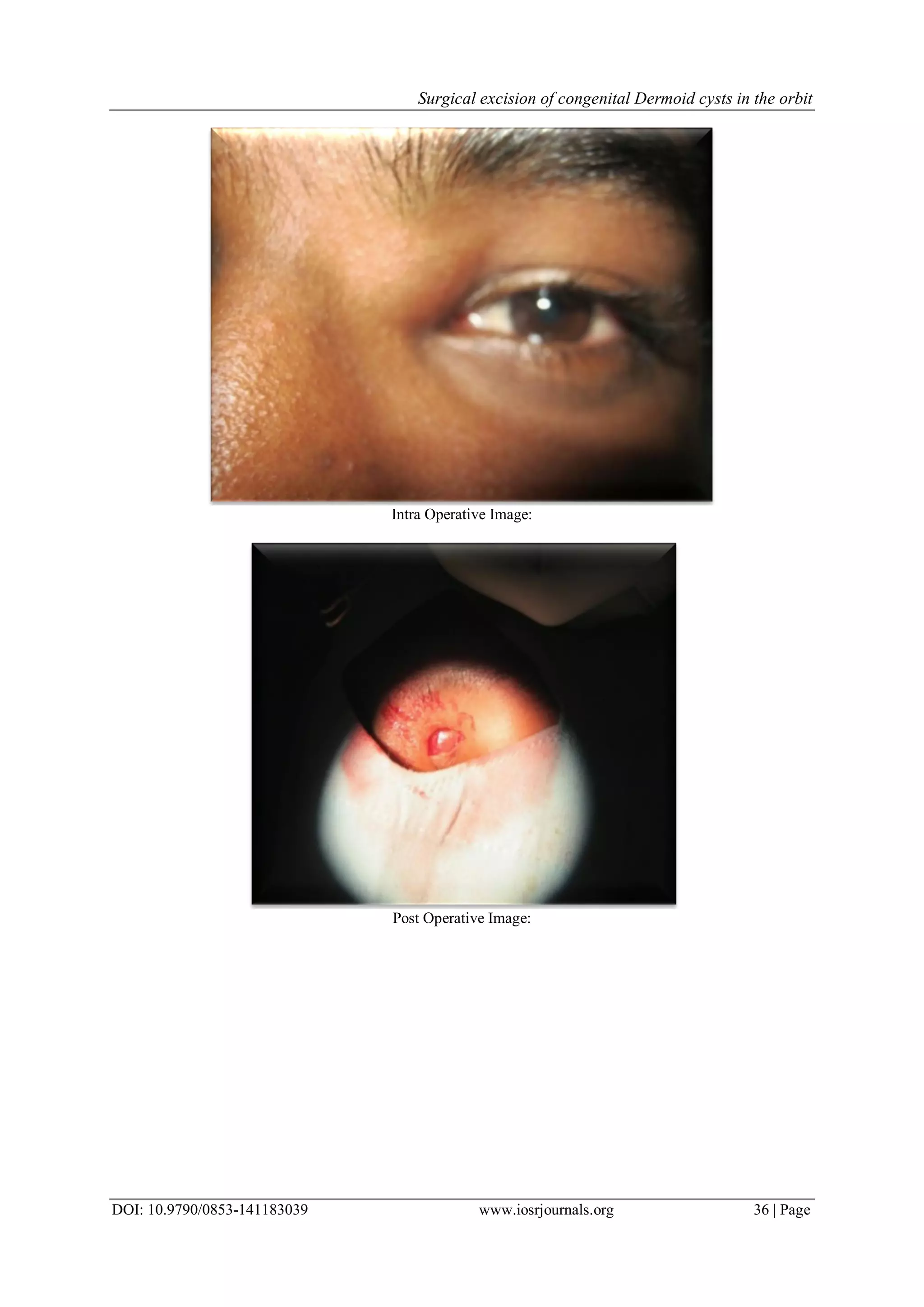 Surgical excision of congenital Dermoid cysts in the orbit | PDF | Eye ...
