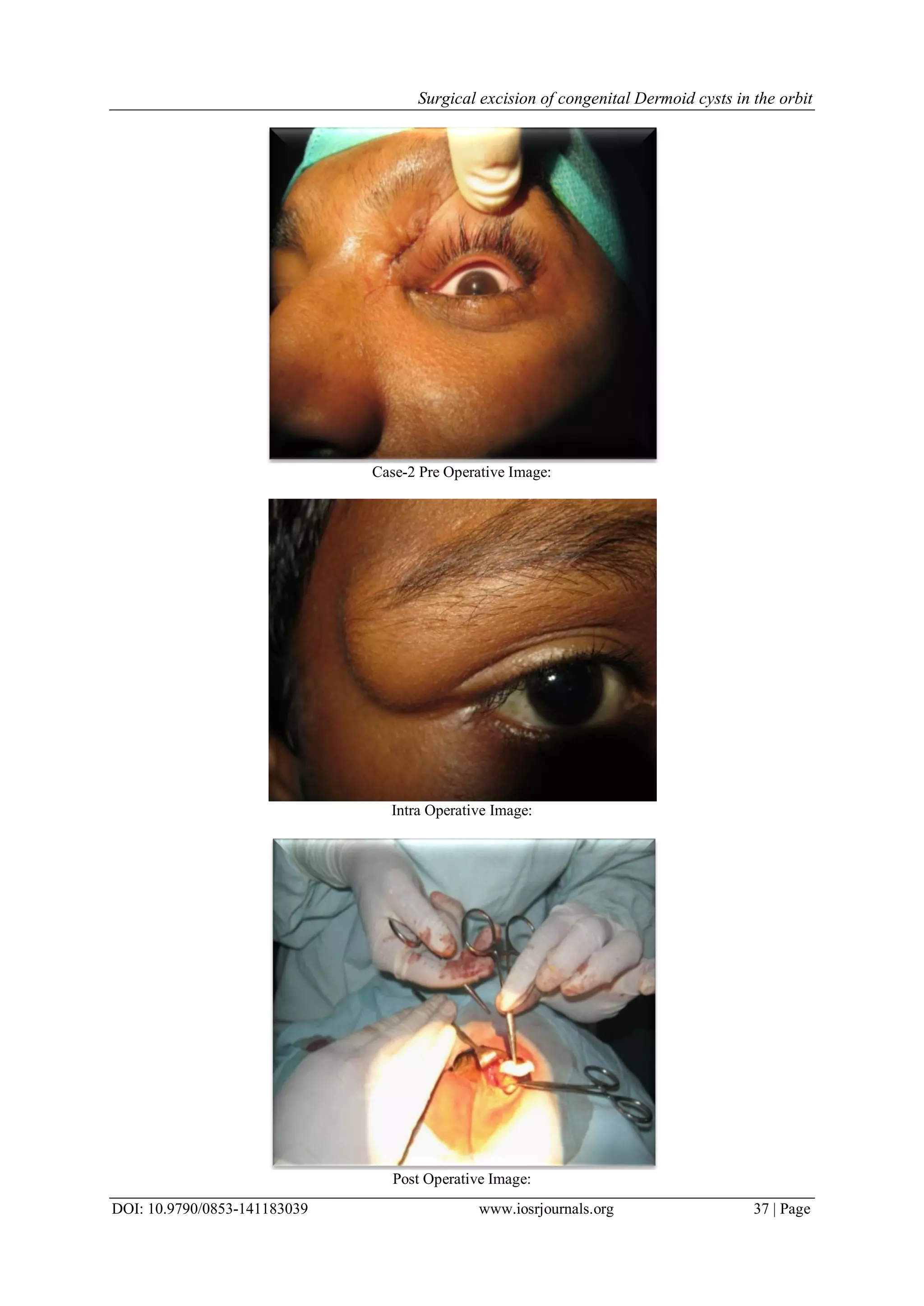 Surgical excision of congenital Dermoid cysts in the orbit | PDF | Eye ...