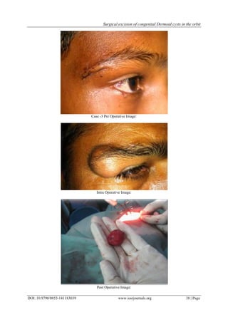 Surgical excision of congenital Dermoid cysts in the orbit | PDF | Eye ...