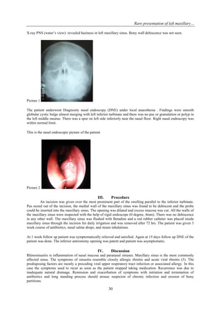 Rare presentation of left maxillary sinusitis: A Case Report | PDF
