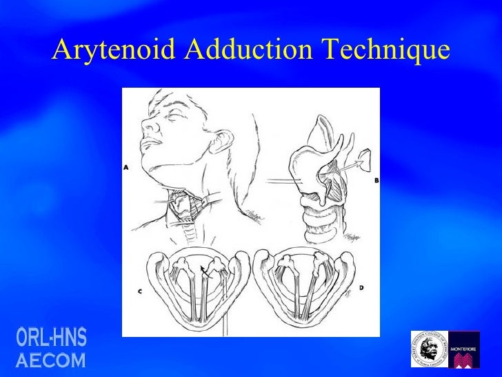 F081 Coclia 75 Phonosurgery