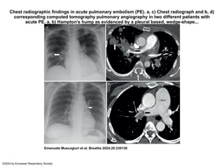 Ct chest pulmonary thromboembolism acute | PPT