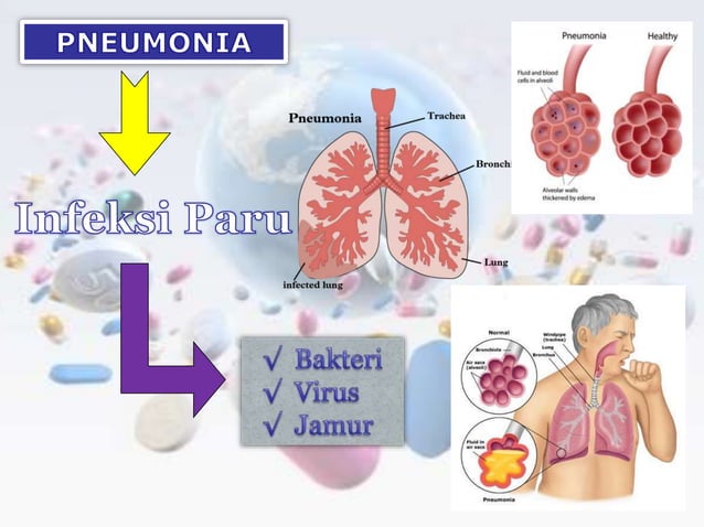 F_13_PNEUMONIA_pptx.pptx