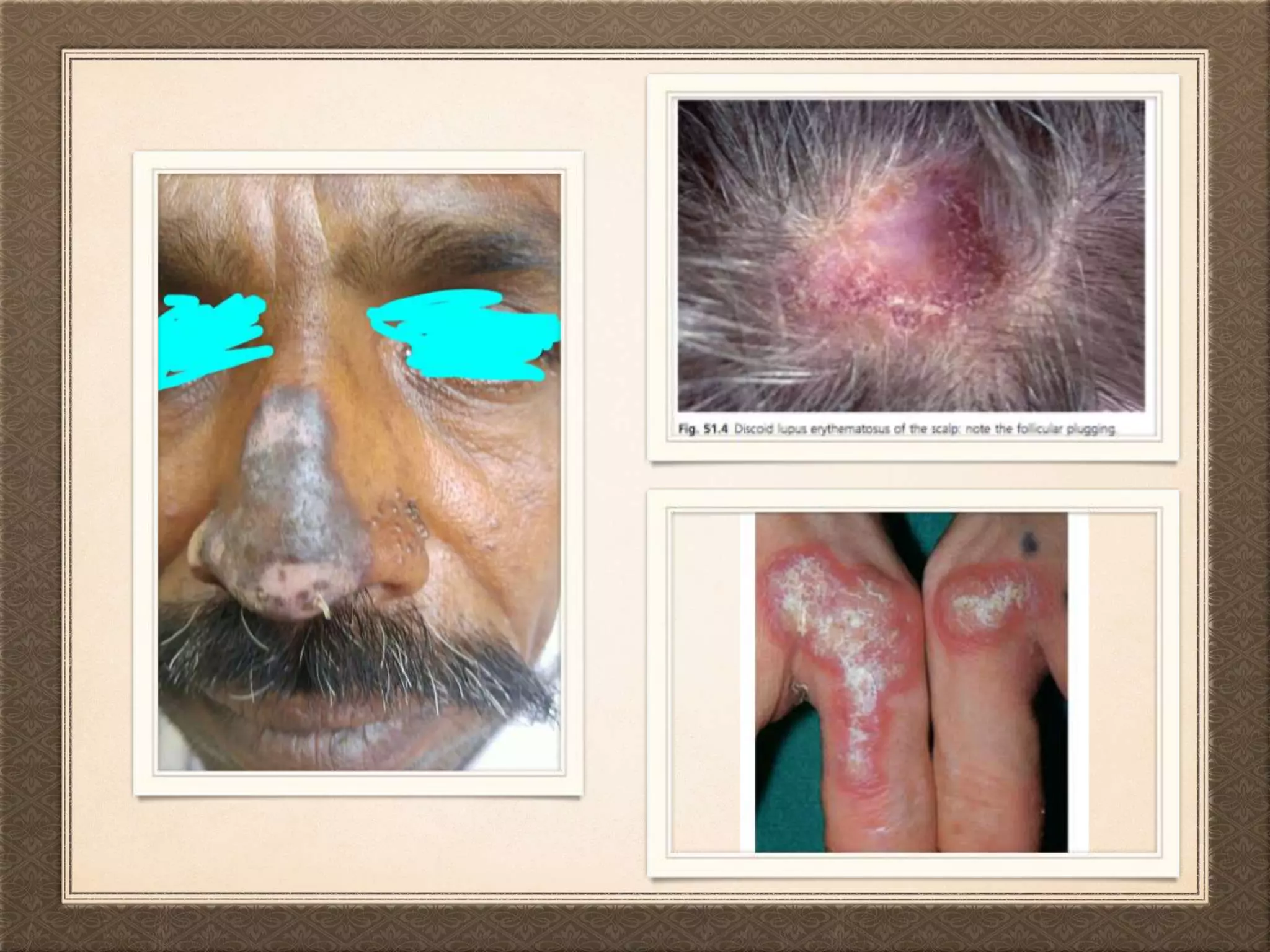 Dermatological manifestation of systemic diseases | PPTX