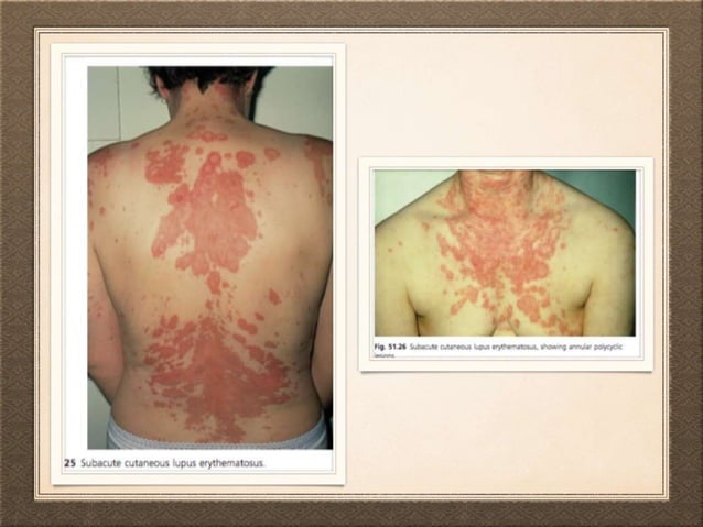 Dermatological manifestation of systemic diseases | PPTX