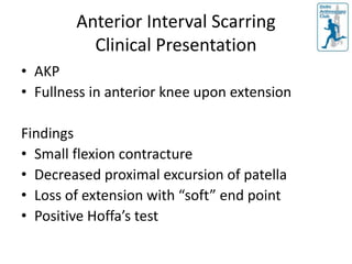 Stiff knee | PPTX