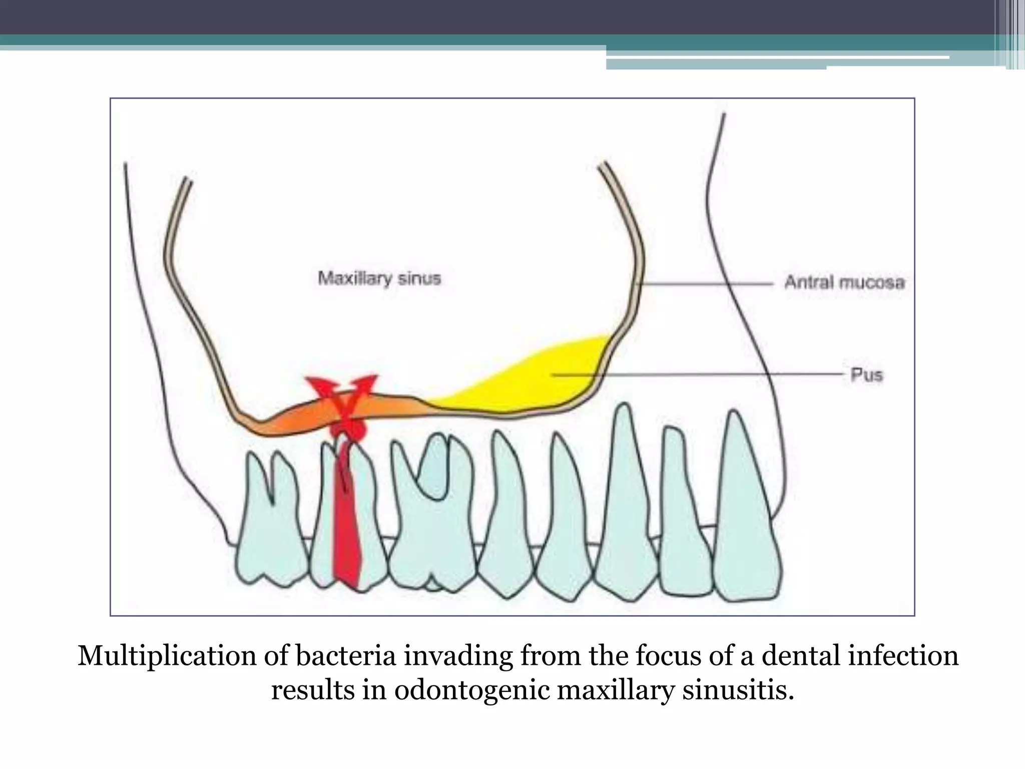 Maxillary Sinusitis - Odontogenic Origin | PPTX