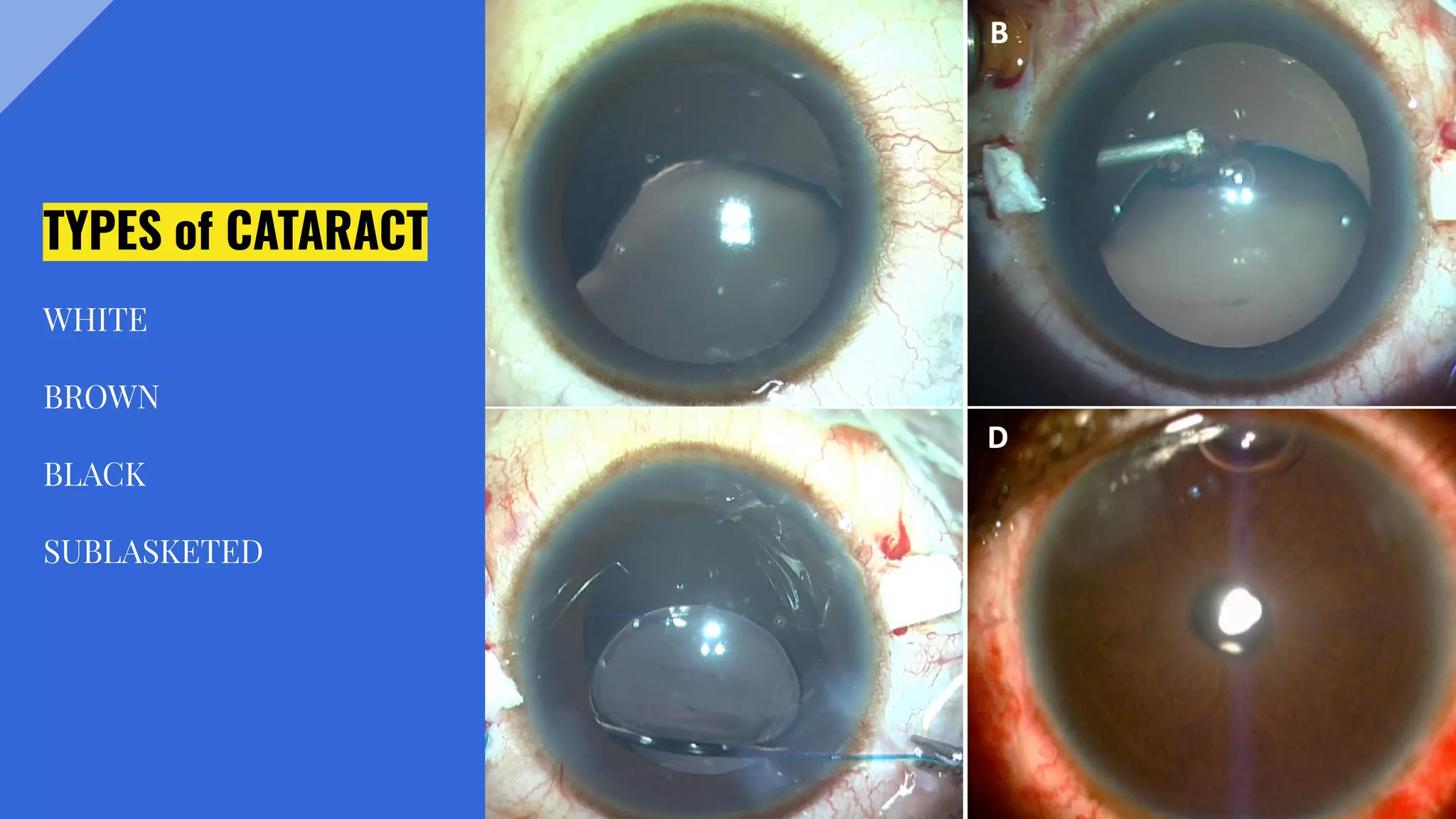 Cataract presentation | PDF