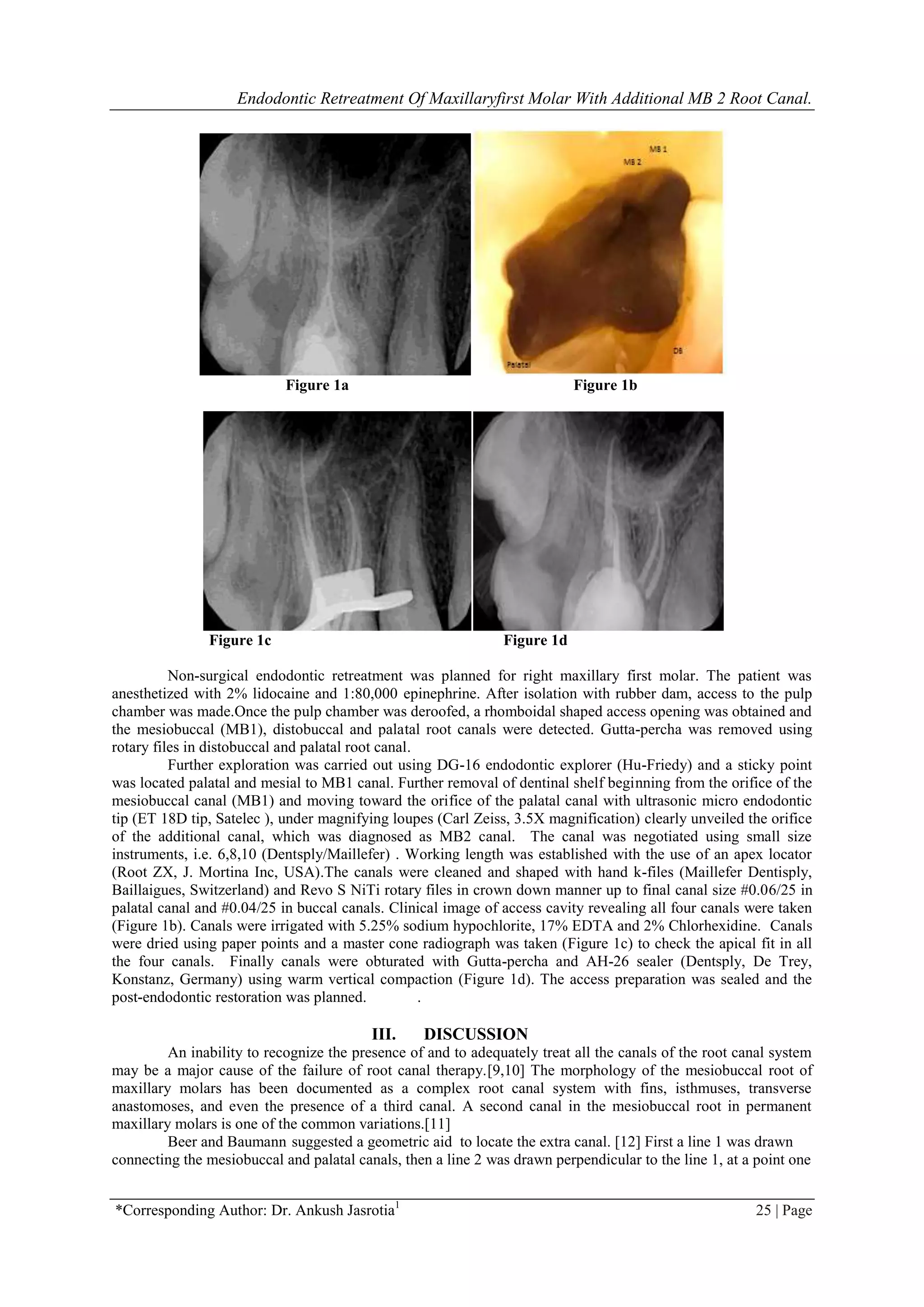 Endodontic Retreatment of Maxillaryfirst Molar with Additional MB 2 ...