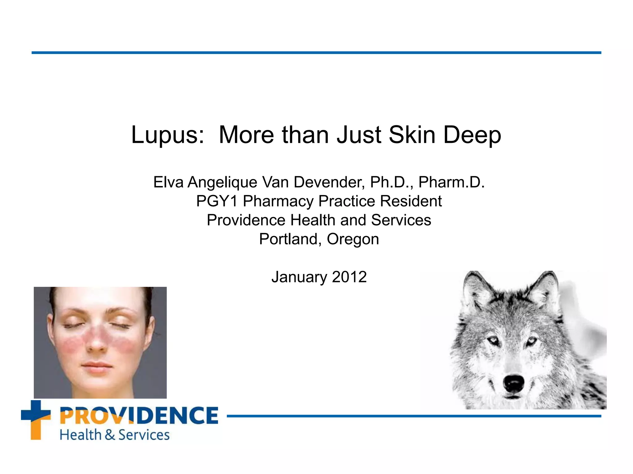 lupus presentation final | PDF