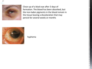 power point of extra material about eye trauma | PPT