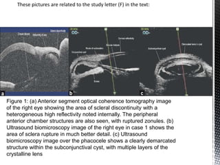 power point of extra material about eye trauma | PPT