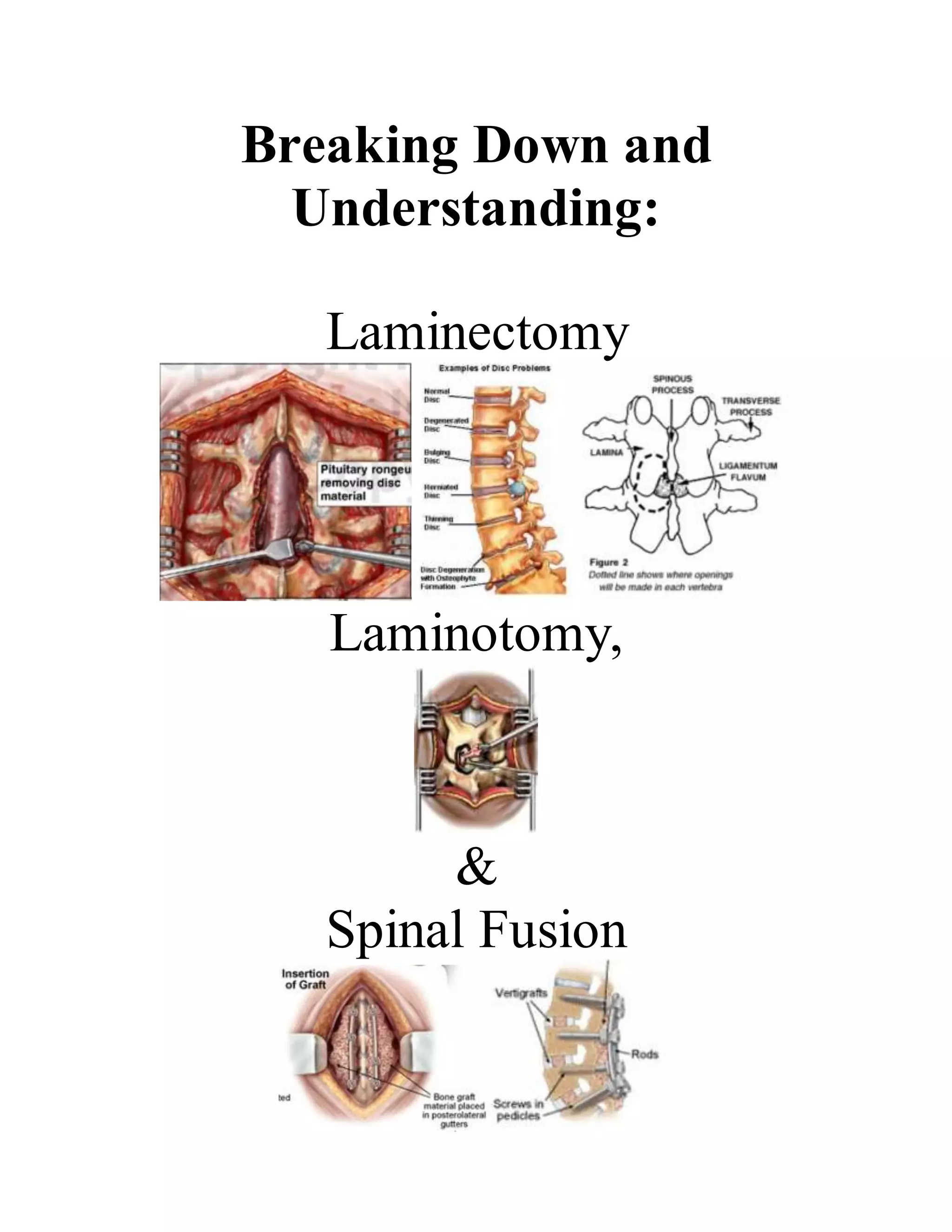 Breaking Down and Understanding Laminotomy, Laminectomy & Spinal Fusion ...