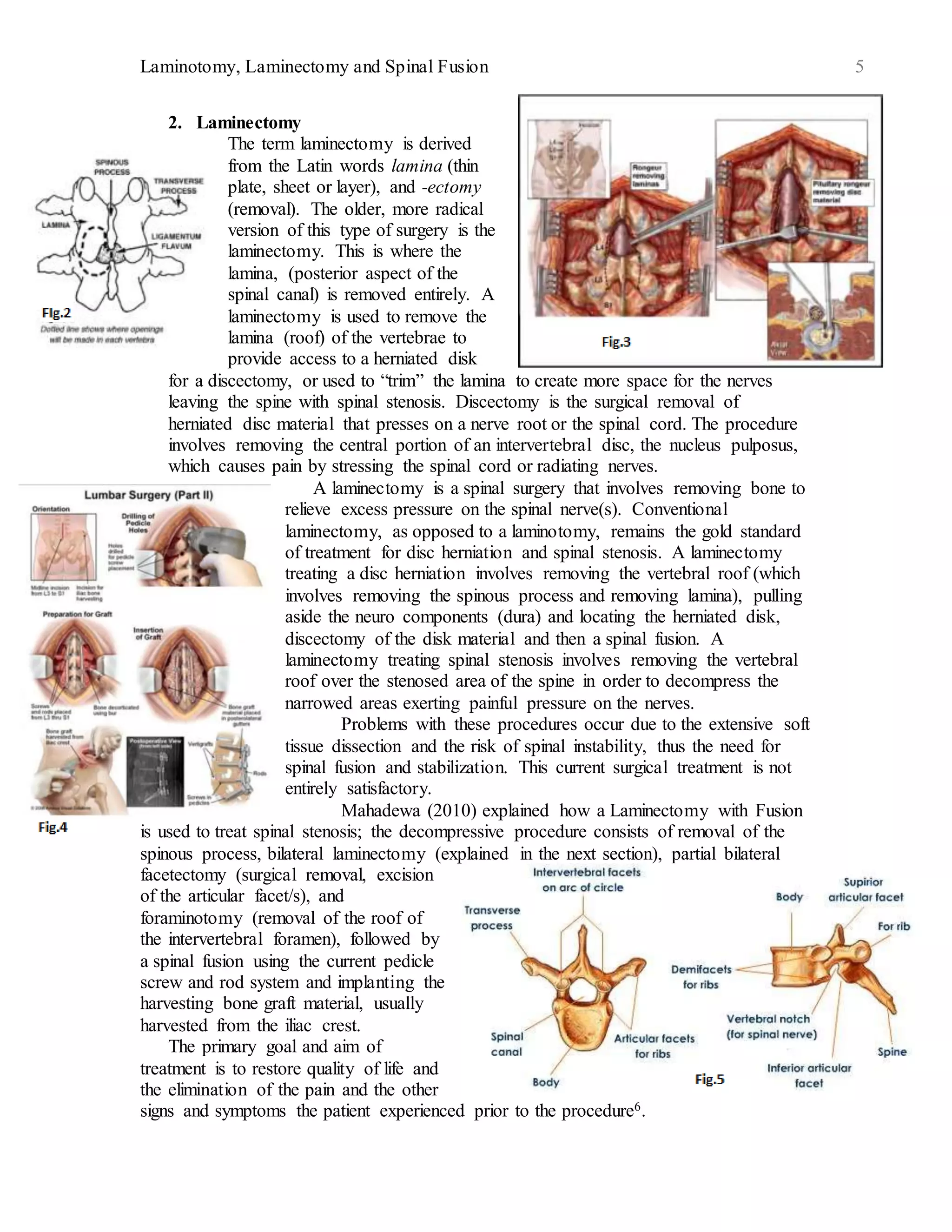 Breaking Down and Understanding Laminotomy, Laminectomy & Spinal Fusion ...