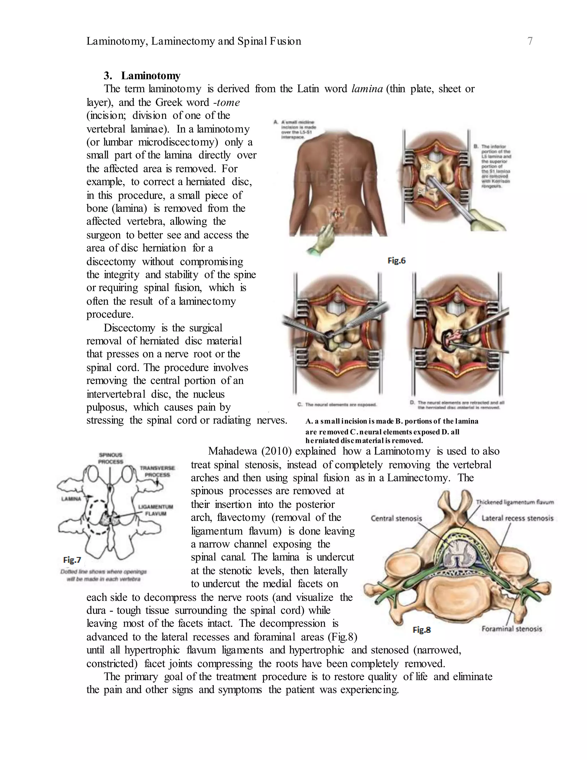 Breaking Down and Understanding Laminotomy, Laminectomy & Spinal Fusion ...