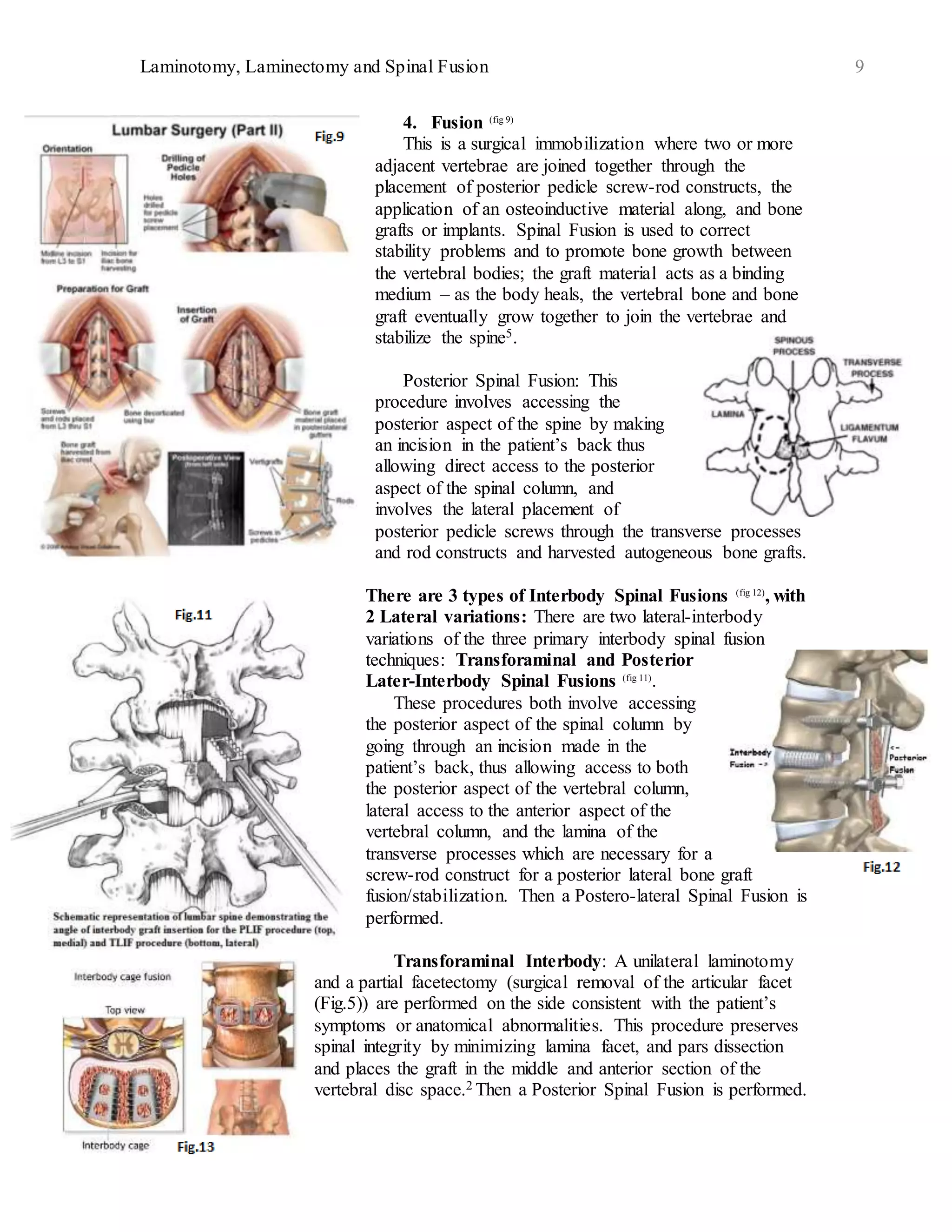 Breaking Down and Understanding Laminotomy, Laminectomy & Spinal Fusion ...