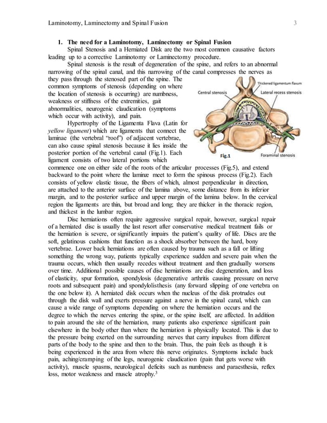 Breaking Down and Understanding Laminotomy, Laminectomy & Spinal Fusion ...